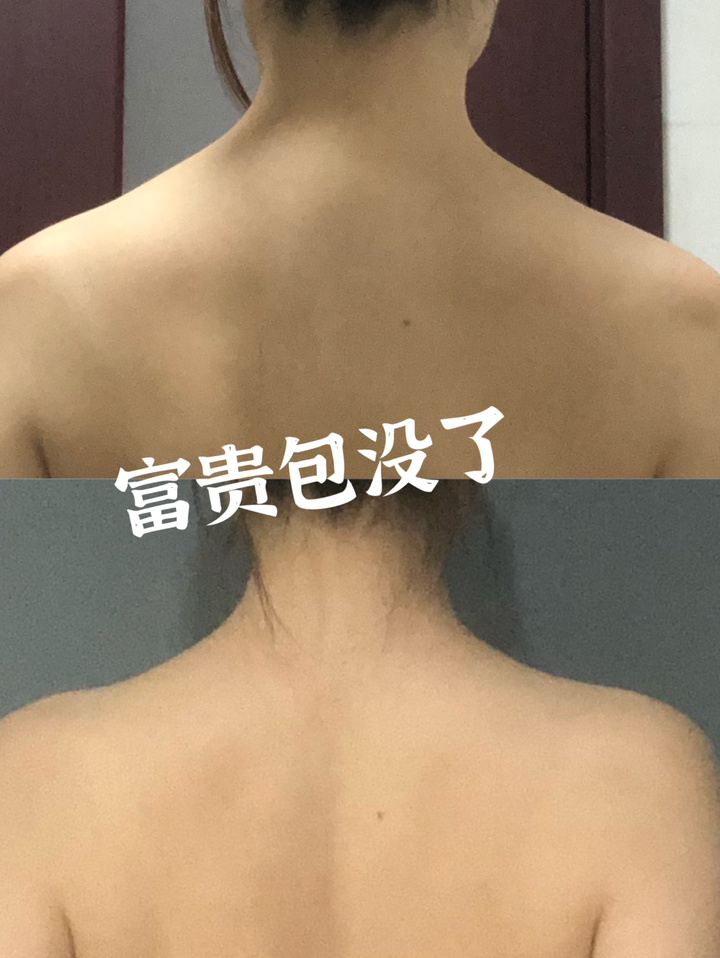 五个动作就可以消除富贵包了👍🏻👍🏻 度小视