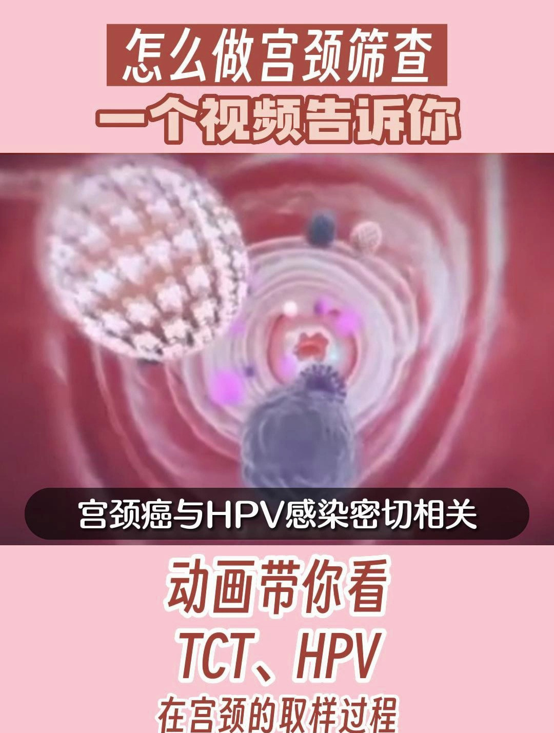 怎么做宫颈筛查？带你看 HPV TCT的取样过程 医学科普-度小视