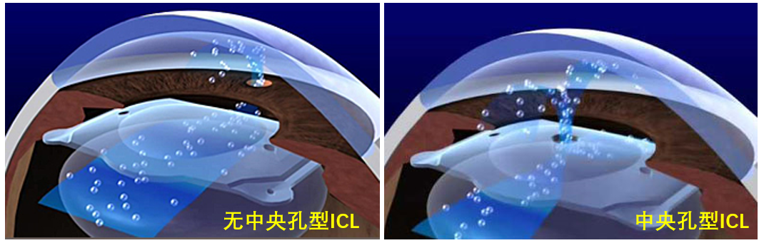 ICL的前世今生——从第一代ICL（ICL20）到V5