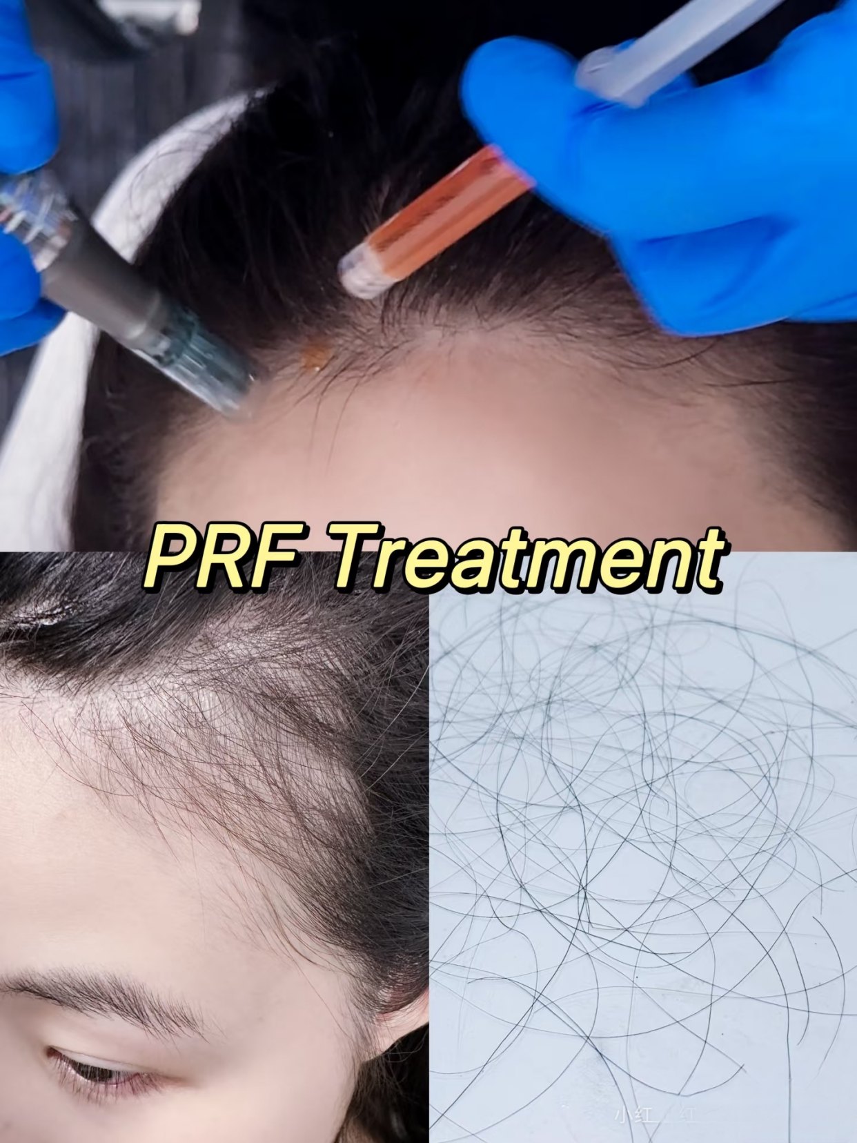 PRP、PRF、CGF，傻傻分不清？