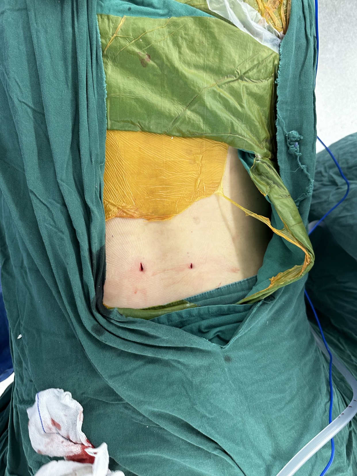 肺癌腰椎骨转移OsteoCool精准消融成型