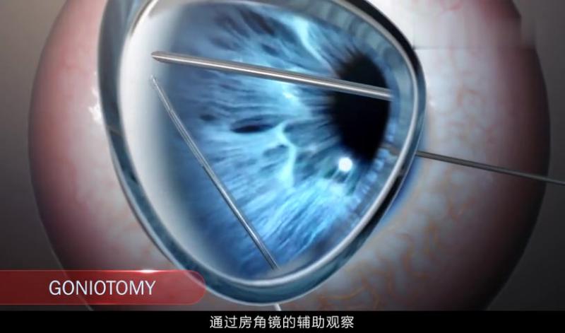 iTrack——内路粘小管成形术ABiC中的微导管,科学,科普,好看视频