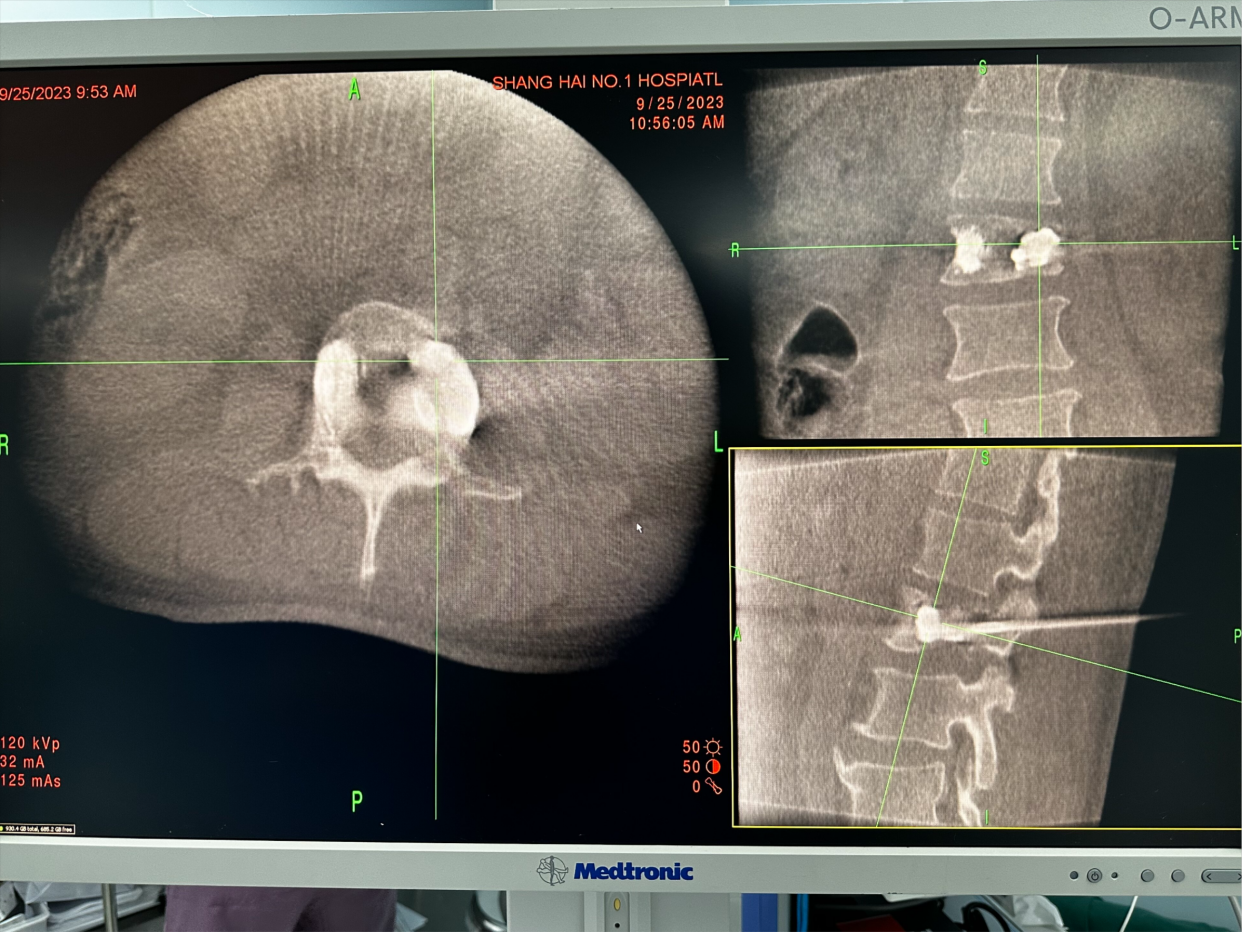 肺癌腰椎骨转移OsteoCool精准消融成型
