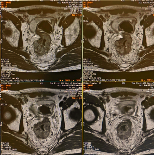 GE SIGNA™ Premier 3.0T磁共振设备在阜阳市肿瘤医院正式投入使用，带来精准清晰的影像检查新体验