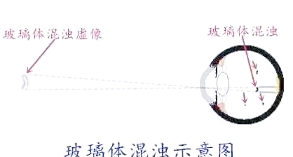 家族遗传眼病：FEVR与ROP的鉴别与治疗