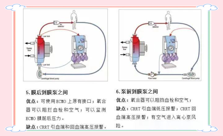 ECMO与CRRT联合治疗的技术要点与常见问题解析