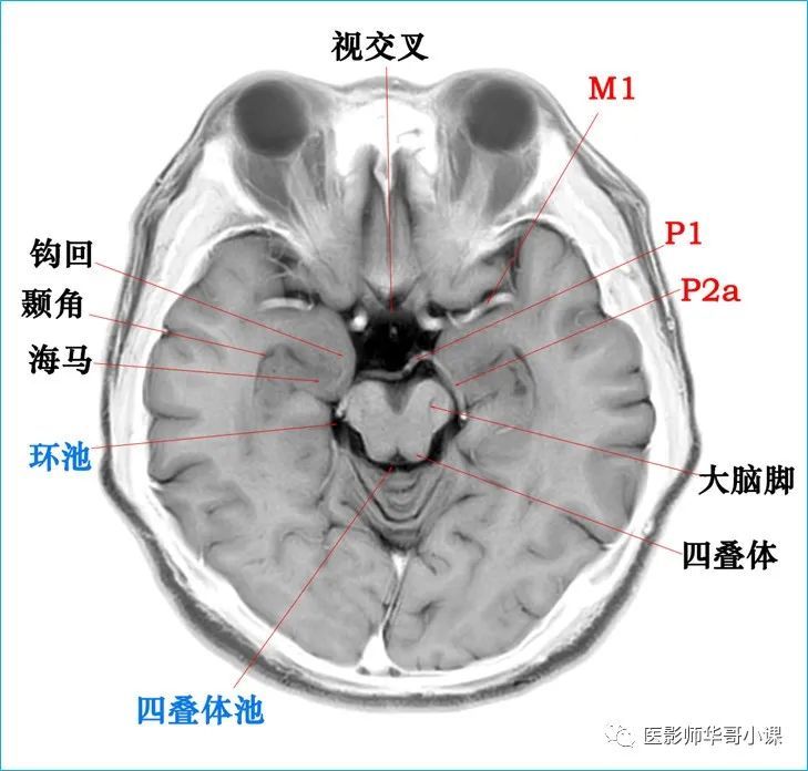 「高清MRI图」颅脑磁共振MRI解剖结构以及高清MR图谱