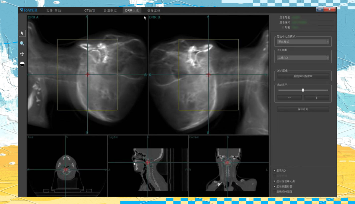 我院引进尖端设备，开启癌症治疗新篇章——iSCOUT图像引导放疗定位系统正式投入使用