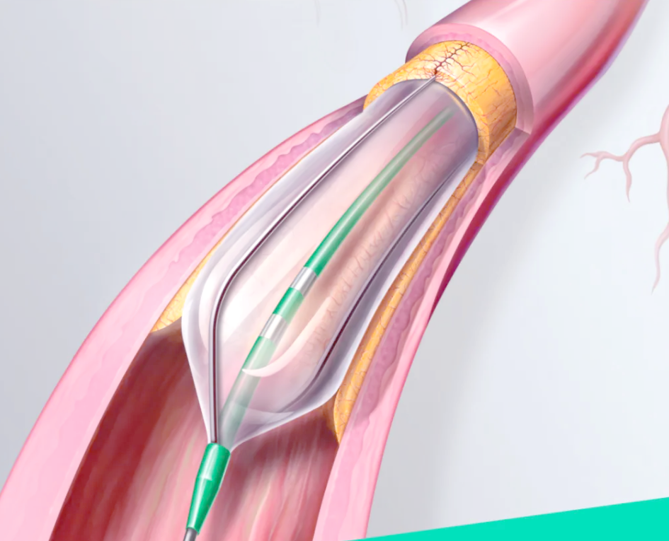 血管介入医疗器械行业特殊球囊产品全面解析