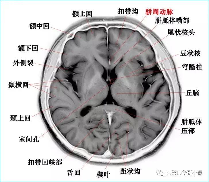 「高清MRI图」颅脑磁共振MRI解剖结构以及高清MR图谱